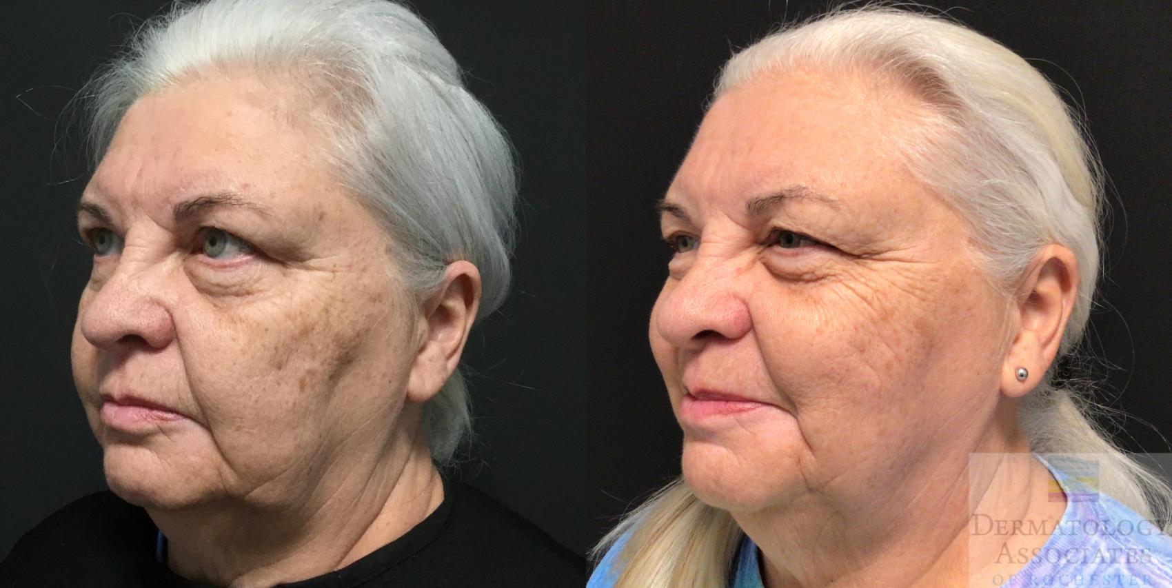 BBL Before and After Pictures Case 73 | Rochester, NY | Dermatology ...