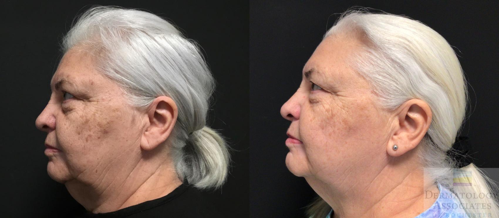 BBL Before and After Pictures Case 73 | Rochester, NY | Dermatology ...