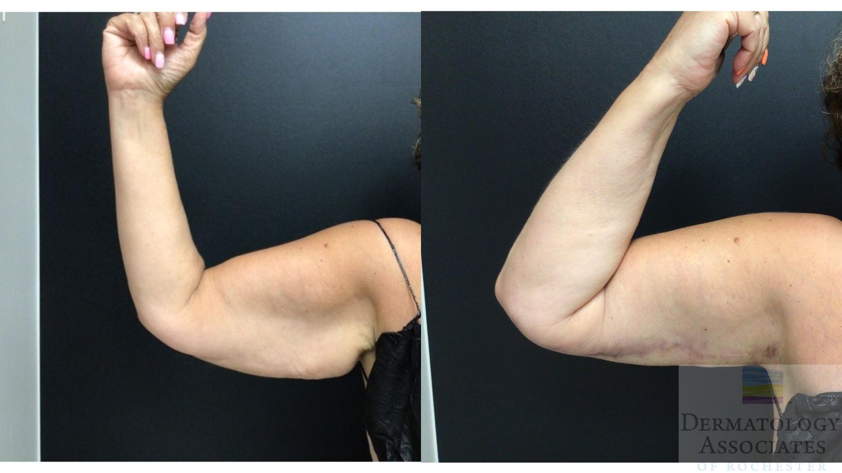 Brachioplasty - arm lift Before and After Pictures Case 14 | Rochester ... Brachioplasty - arm lift Before and After Pictures Case 14 | Rochester ...